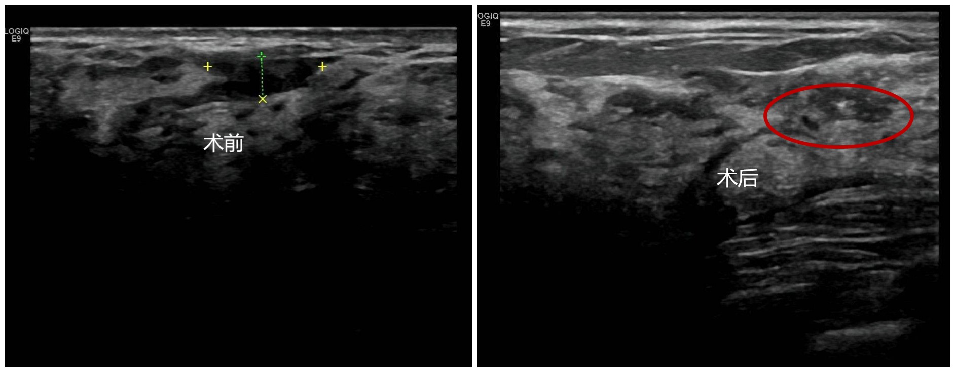 乳房结节BI-RADS 4A类，是乳腺纤维腺瘤？还是乳腺癌？-医疗科普-百度健康
