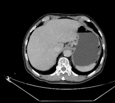 高龄胃癌患者如何治疗，免疫+化疗效果明显！-医疗科普-百度健康