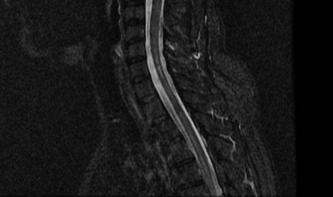 药物治疗配合床旁康复治疗脊髓空洞症疗效突出-医疗科普-百度健康